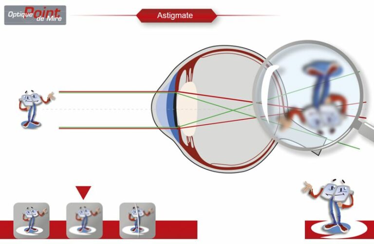 Quels sont les troubles visuels fréquents ? - Optique Point de Mire